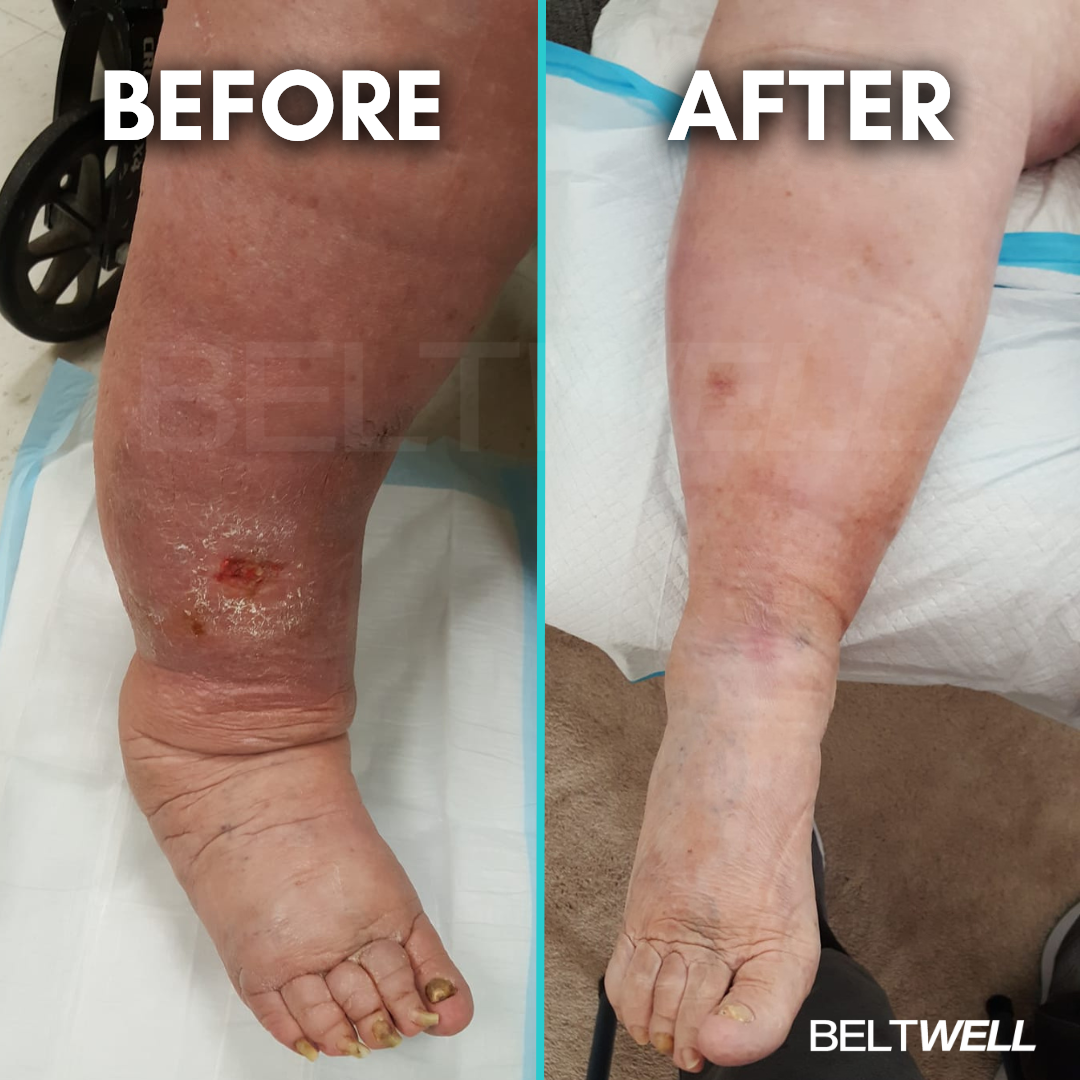 Beltwell® - The Full Foot & Calf Compression System For Swelling ...