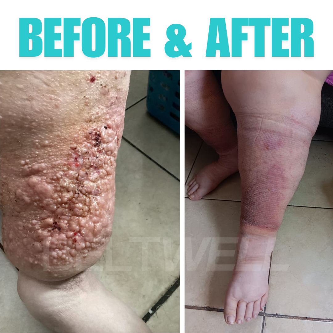 Beltwell® - The Full-Leg Compression Wrap System — Beltwell